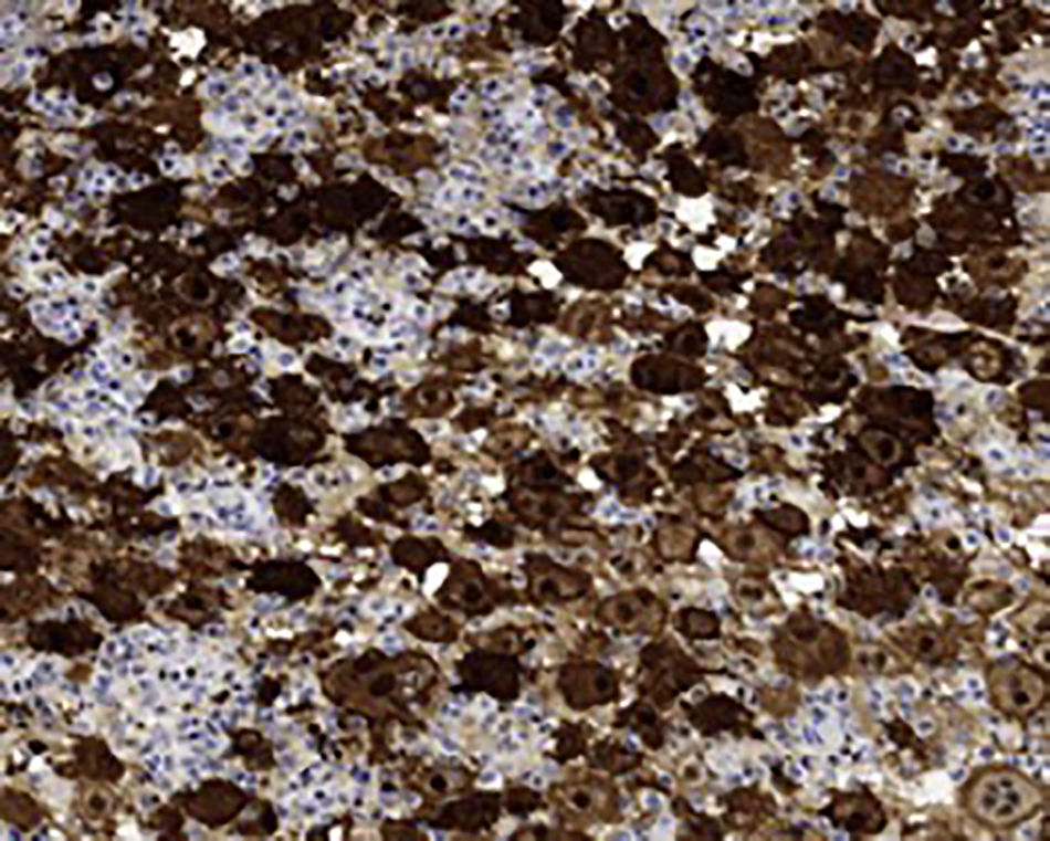 Pápula eritematosa en el muslo simulando un fibroma cutáneo | Piel ...