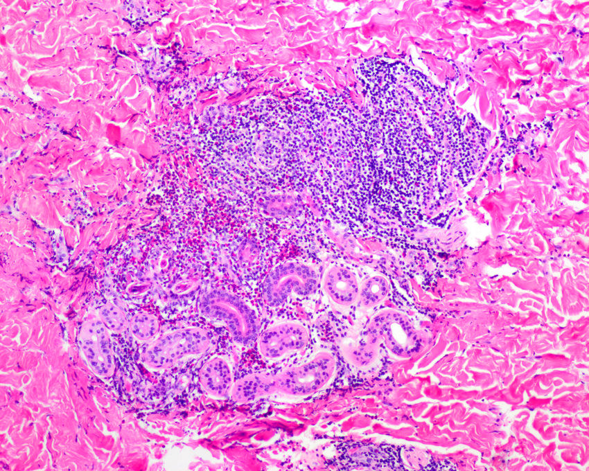 Dermatitis por cercarias. Diagnóstico y tratamiento en la práctica ...