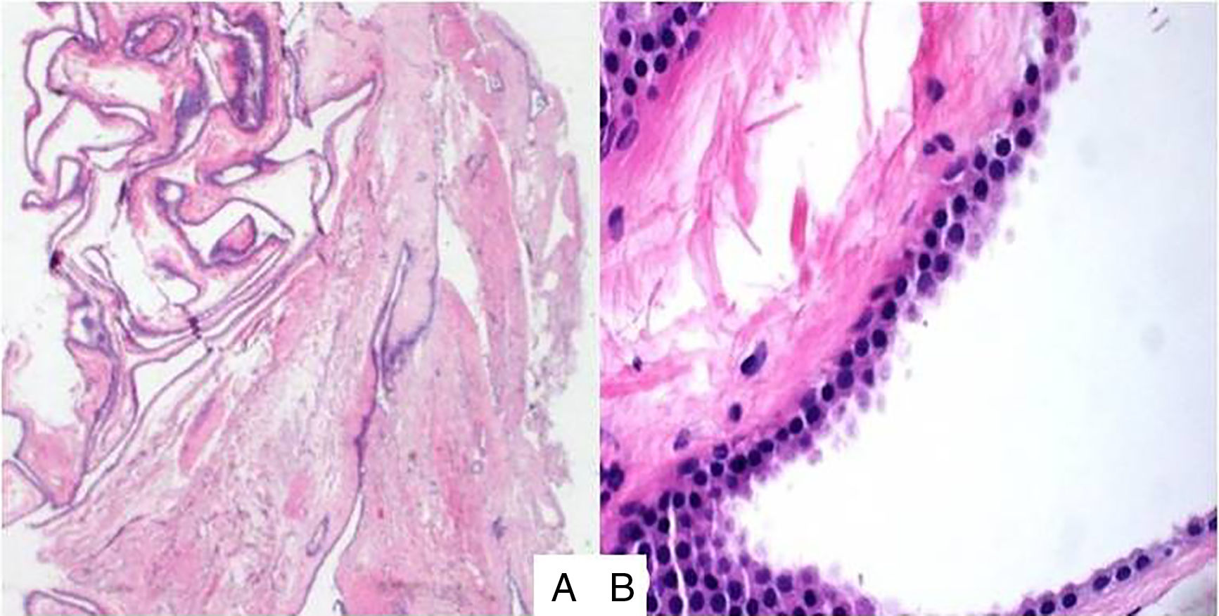 Una pápula azul en la mejilla | Piel. Formación continuada en dermatología