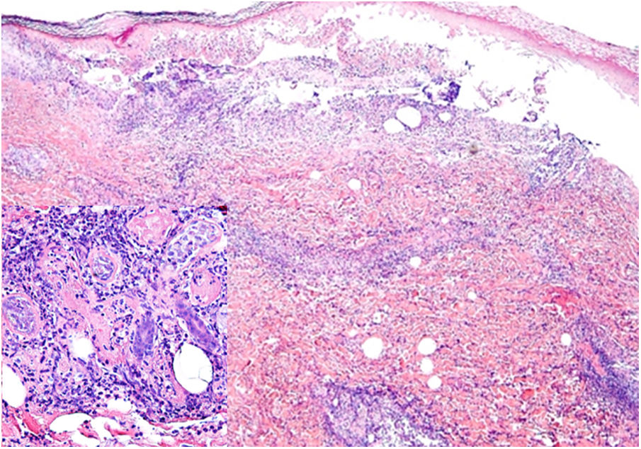 Necrosis cutánea inducida por warfarina | Piel. Formación continuada en ...