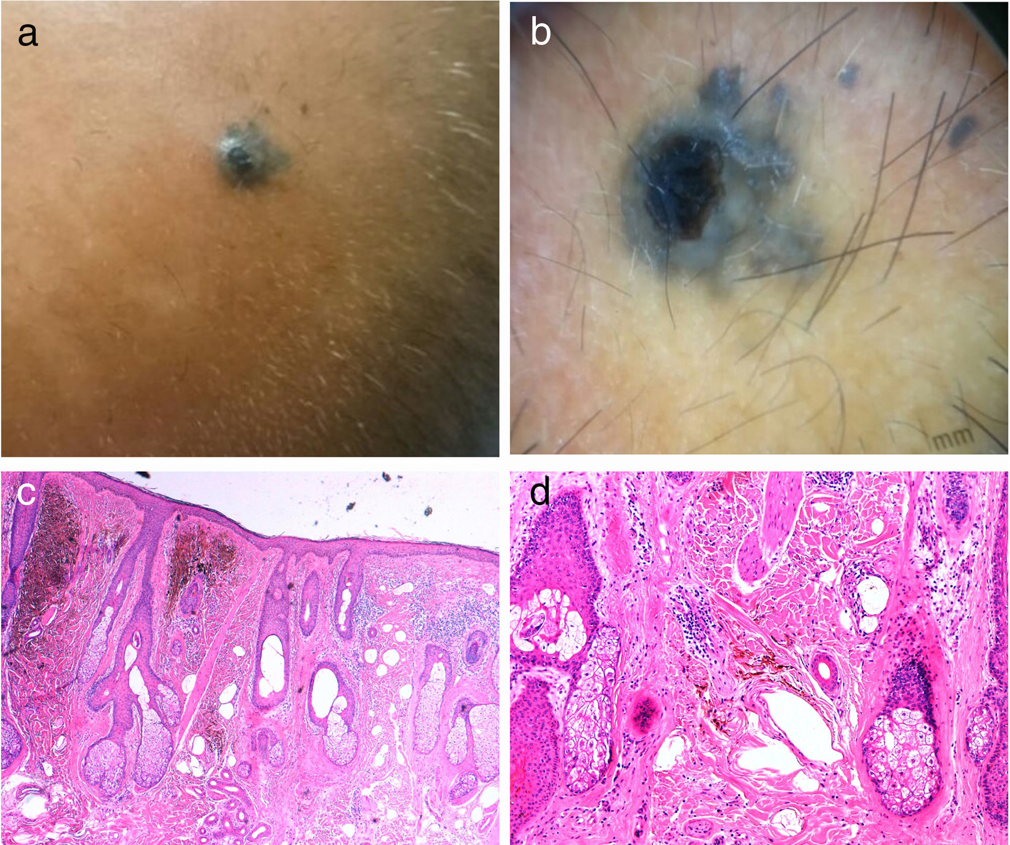 Nevus azul con satelitosis: la importancia de su diferenciación con el ...