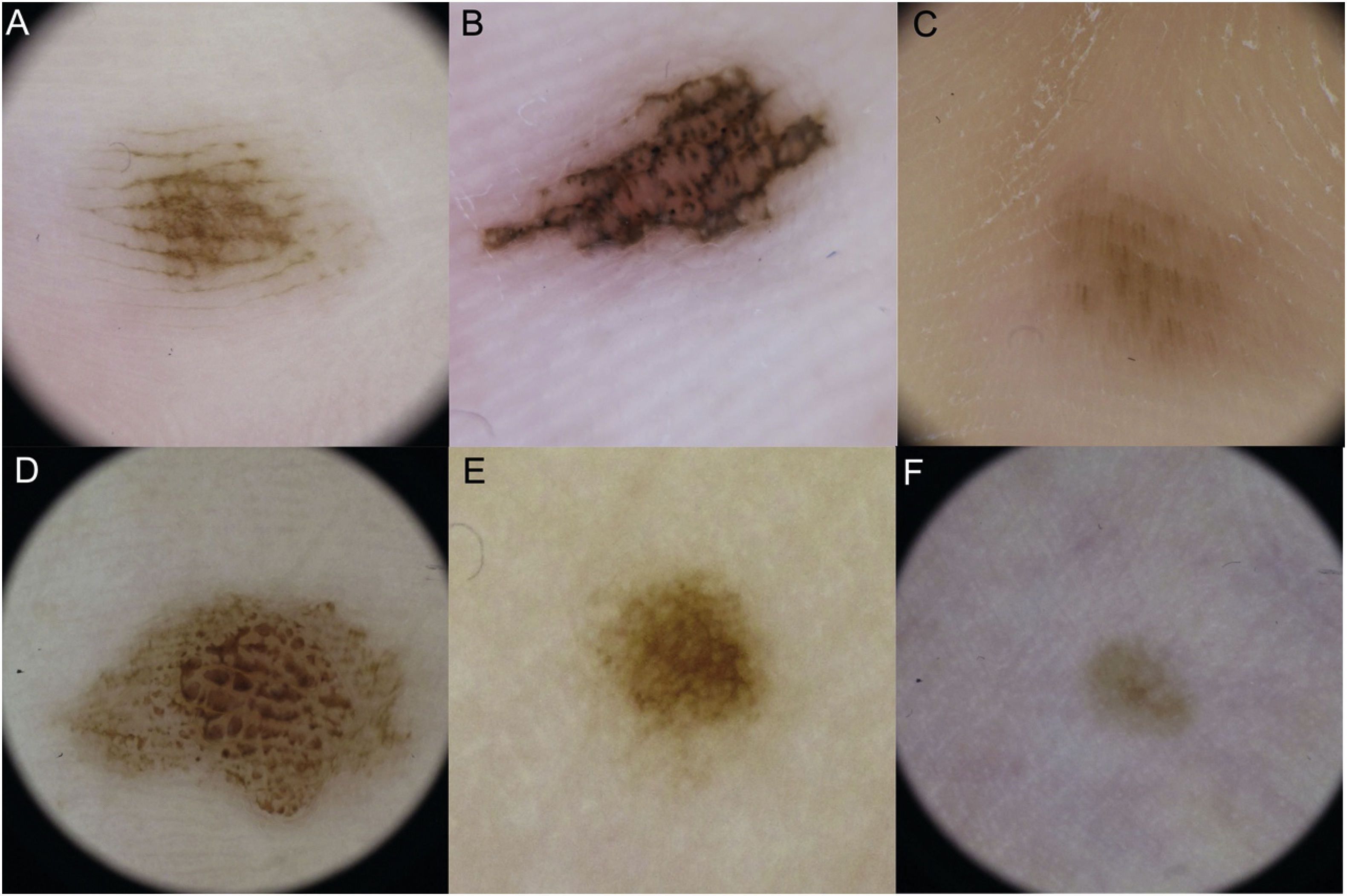 Características clínicas y dermatoscópicas de los nevus melanocíticos ...