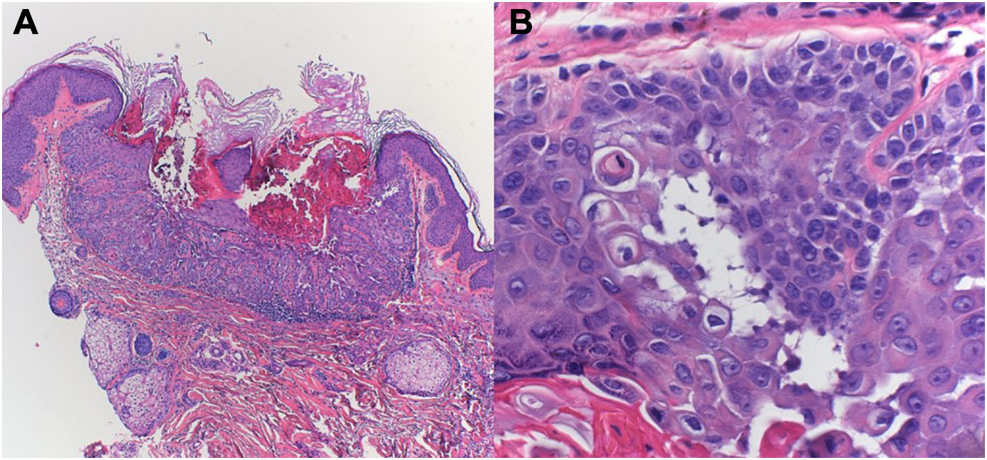 Una pápula frontal peculiar | Piel. Formación continuada en dermatología