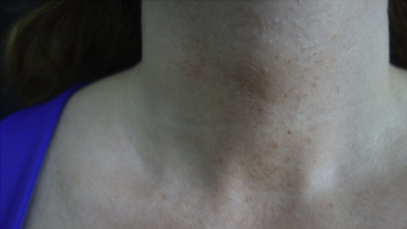 Lo que esconde el «signo de Darier» | Piel. Formación continuada en ...