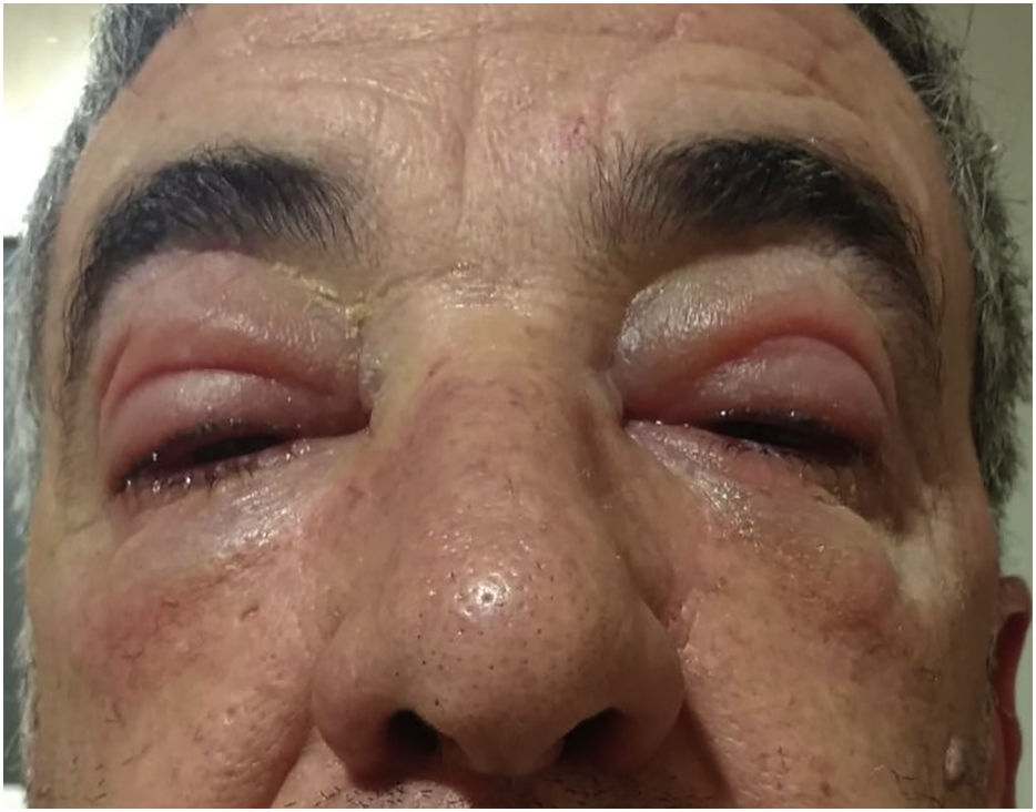 Dermatitis alérgica de contacto palpebral tras la aplicación de un ...