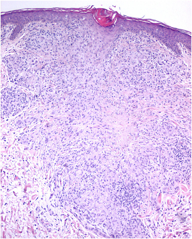 Pápulas eritematosas faciales intensamente pruriginosas | Piel ...