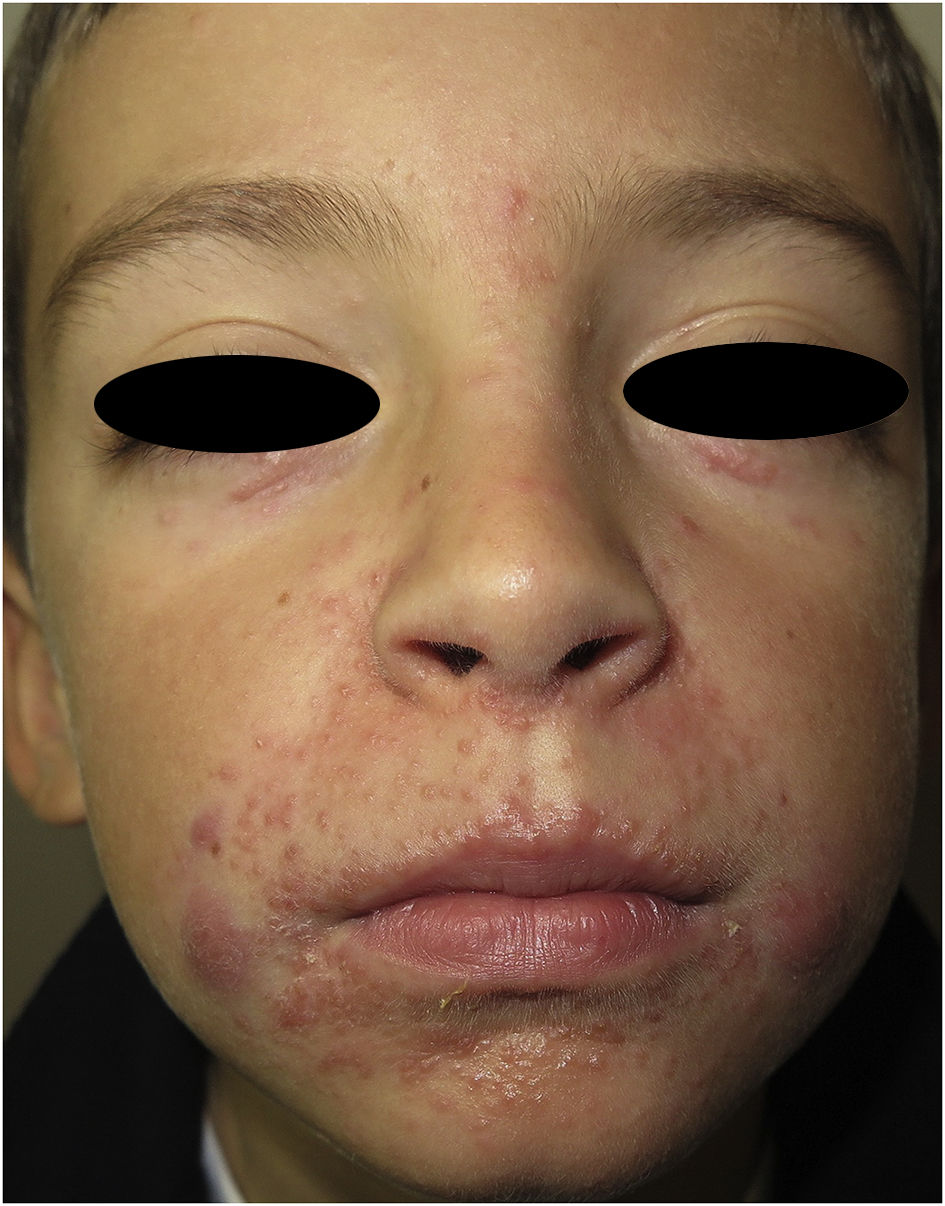 Presentación simultánea de granuloma aséptico facial bilateral y ...