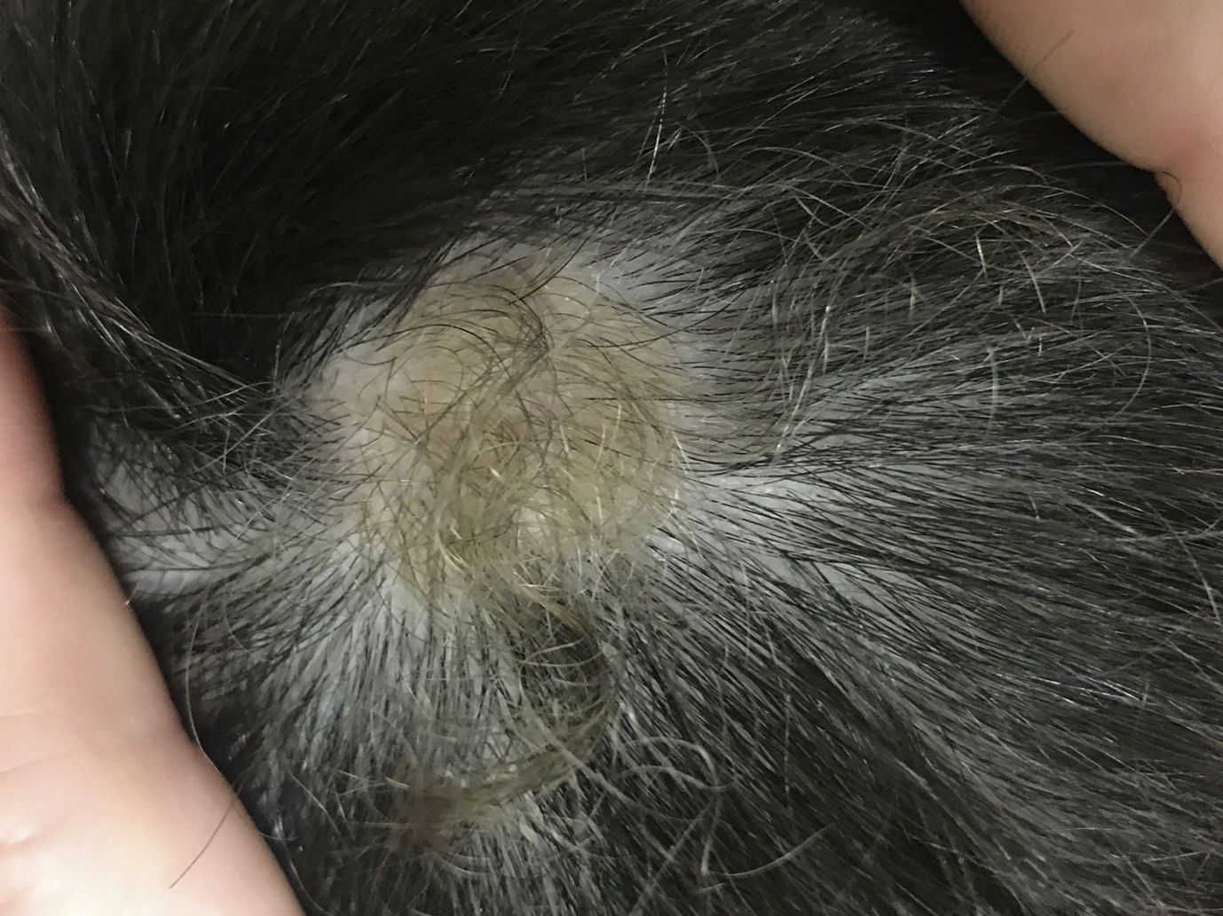 Nevus de pelo lanoso, un diagnóstico clínico fácil | Piel. Formación ...