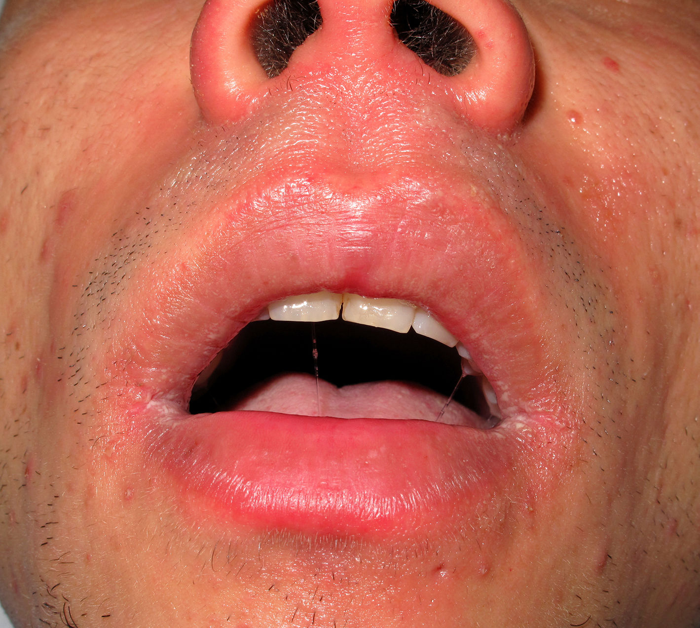 Dermatitis en la cara y el pene por poppers | Piel. Formación ...