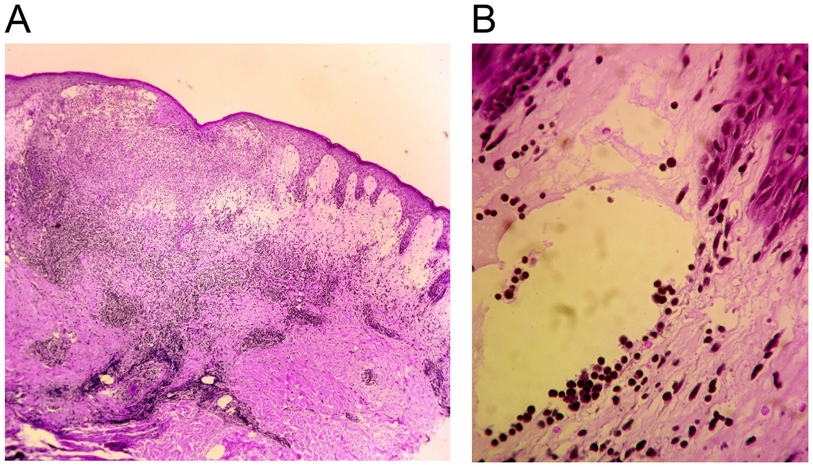 Ampollas y placas costrosas de distribución zosteriforme | Piel ...