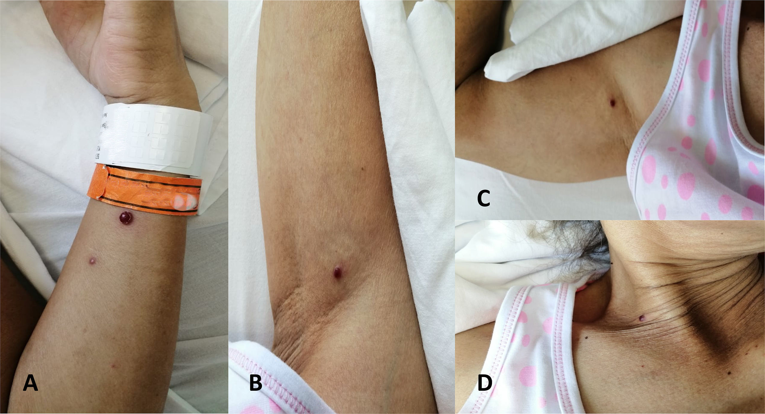 Angiomatosis bacilar en una paciente inmunosuprimida en un país no ...