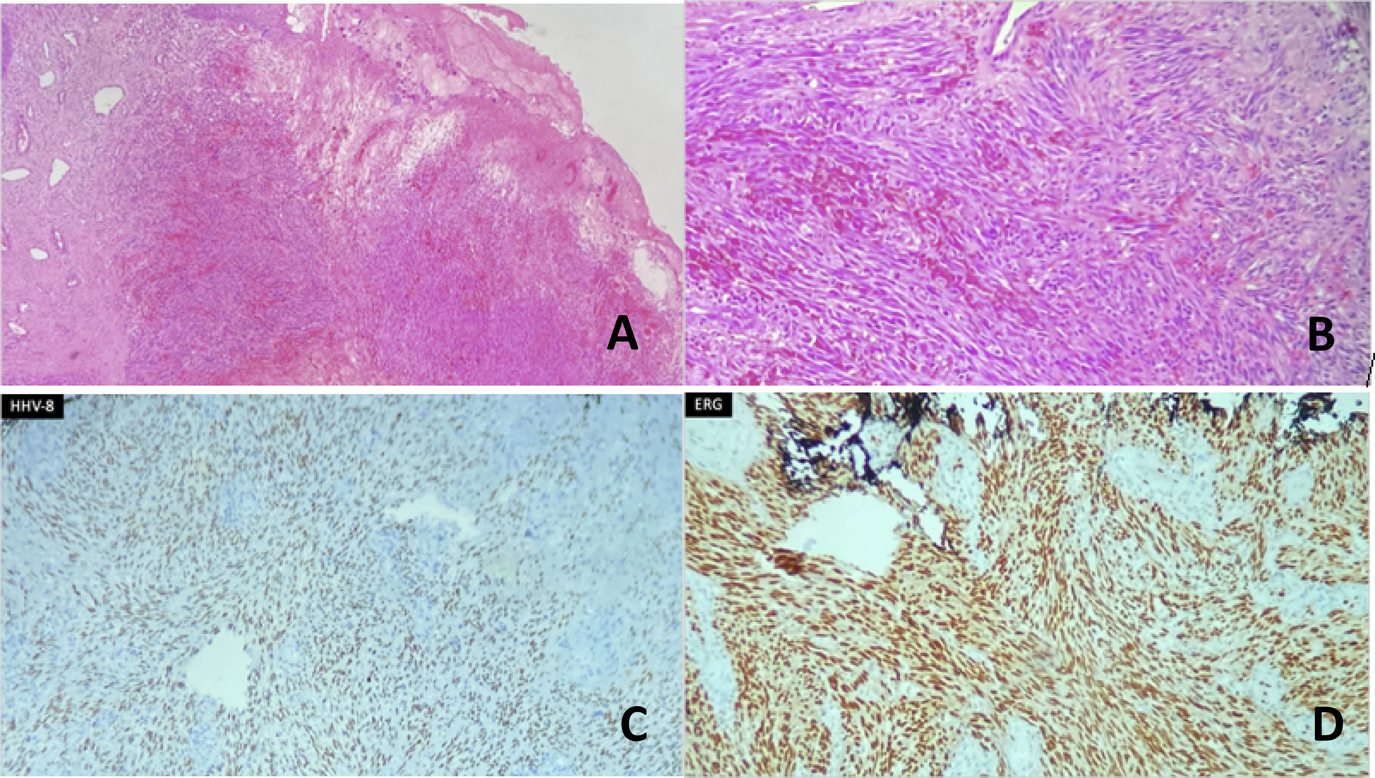 Sarcoma de Kaposi iatrogénico asociado a la leucemia mieloide crónica y ...