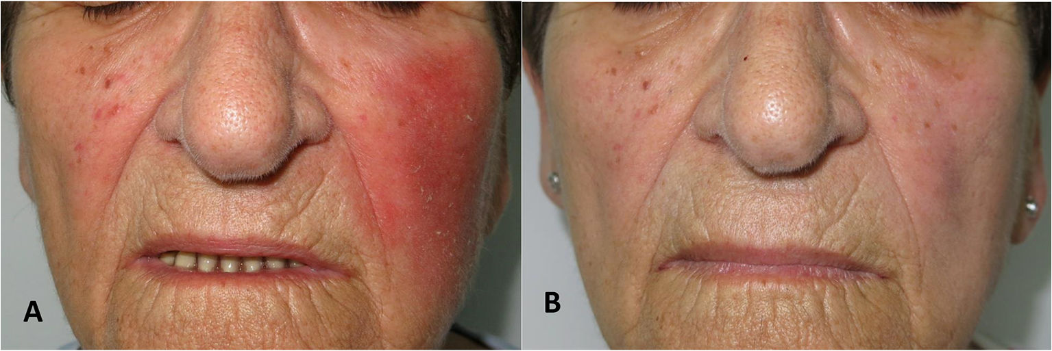 Demodicosis facial tratada exitosamente con ivermectina oral | Piel ...