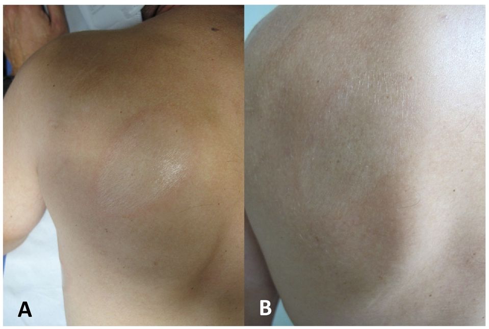 Morfea en placas múltiples en un paciente con esclerosis múltiple en ...