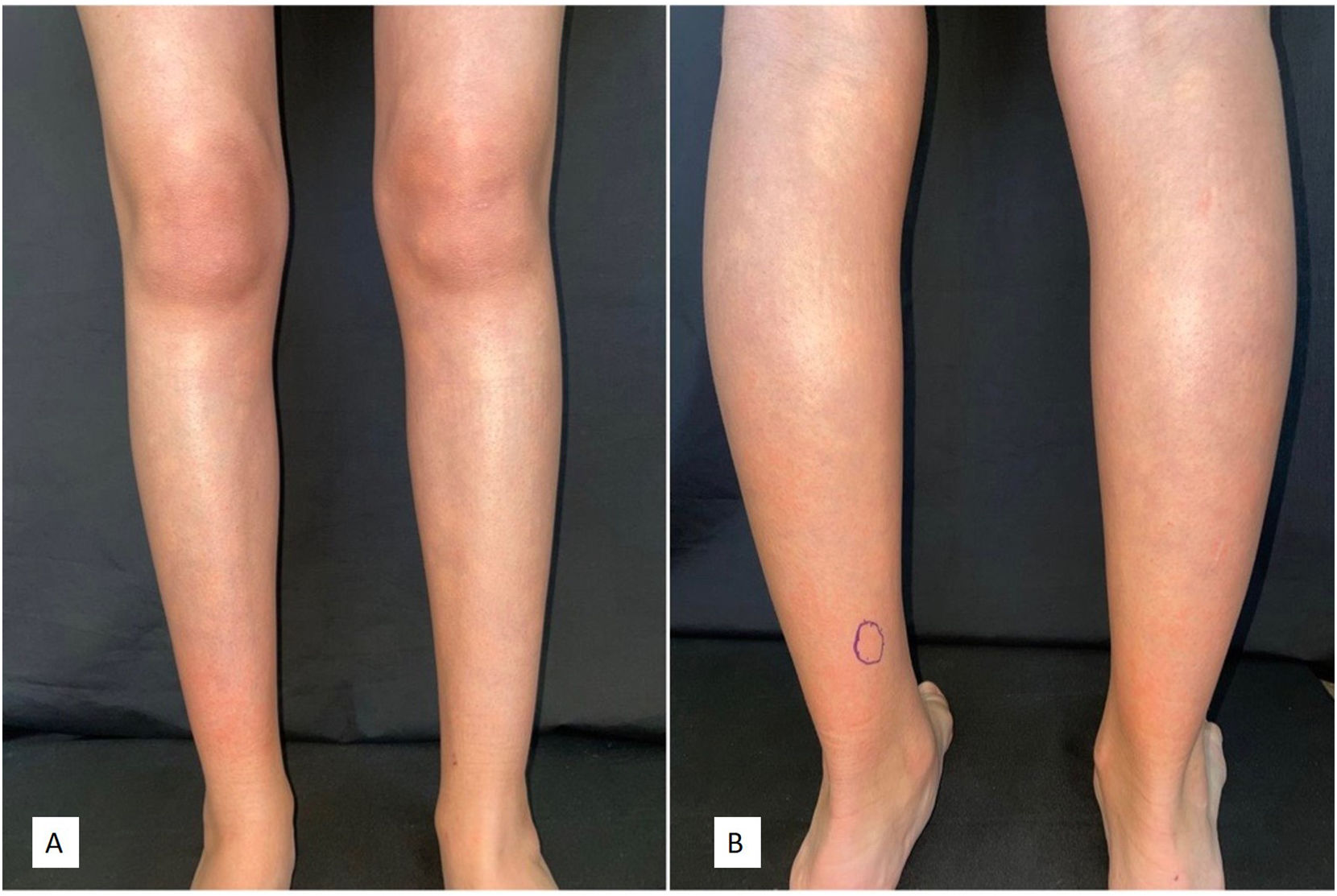 Síndrome de BASCULE, reconocer y diagnosticar es la clave | Piel ...