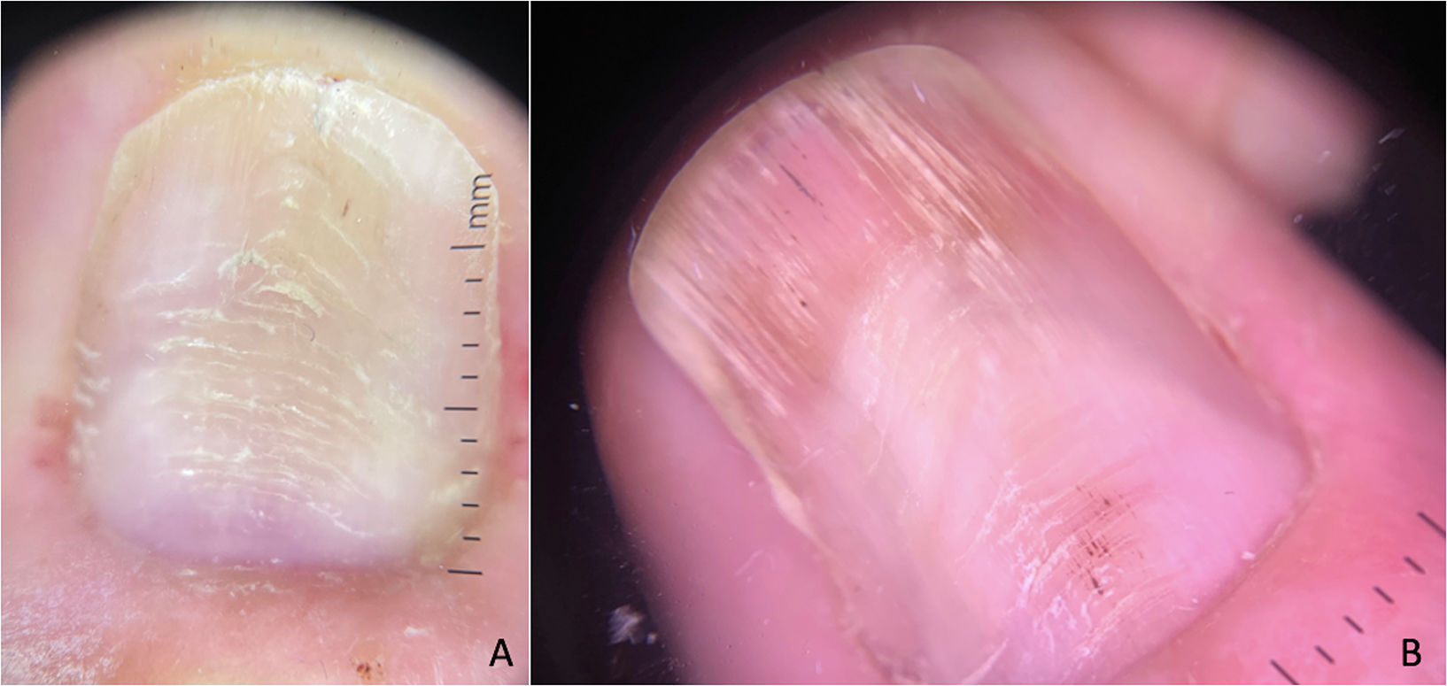 Deformidad por habit ticHabit Tic deformity | Piel. Formación ...