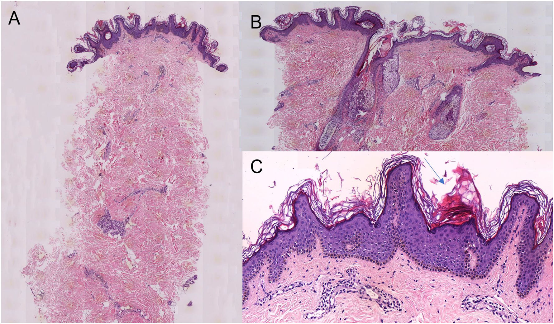 Placas hiperpigmentadas confluentes en una adolescente | Piel ...