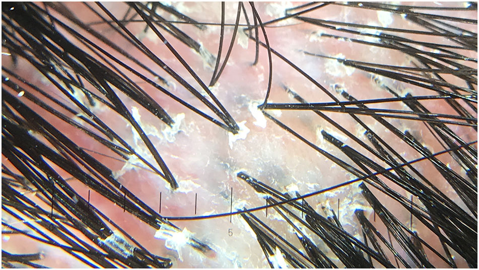Foliculitis decalvante | Piel. Formación continuada en dermatología