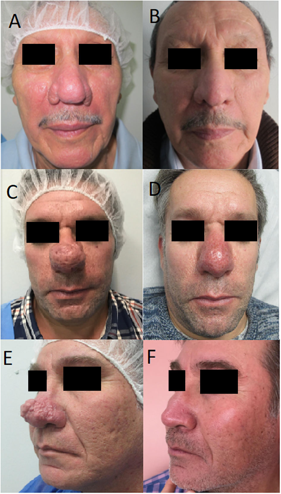 Tratamiento del rinofima con láser de dióxido de carbono ablativo modo ...