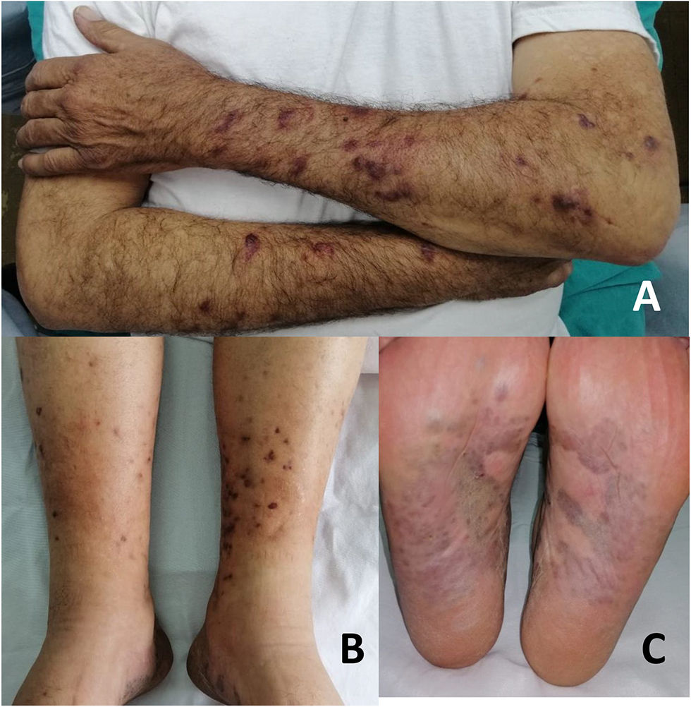 Sarcoma de Kaposi clásico con reacción adversa al tratamiento con ...