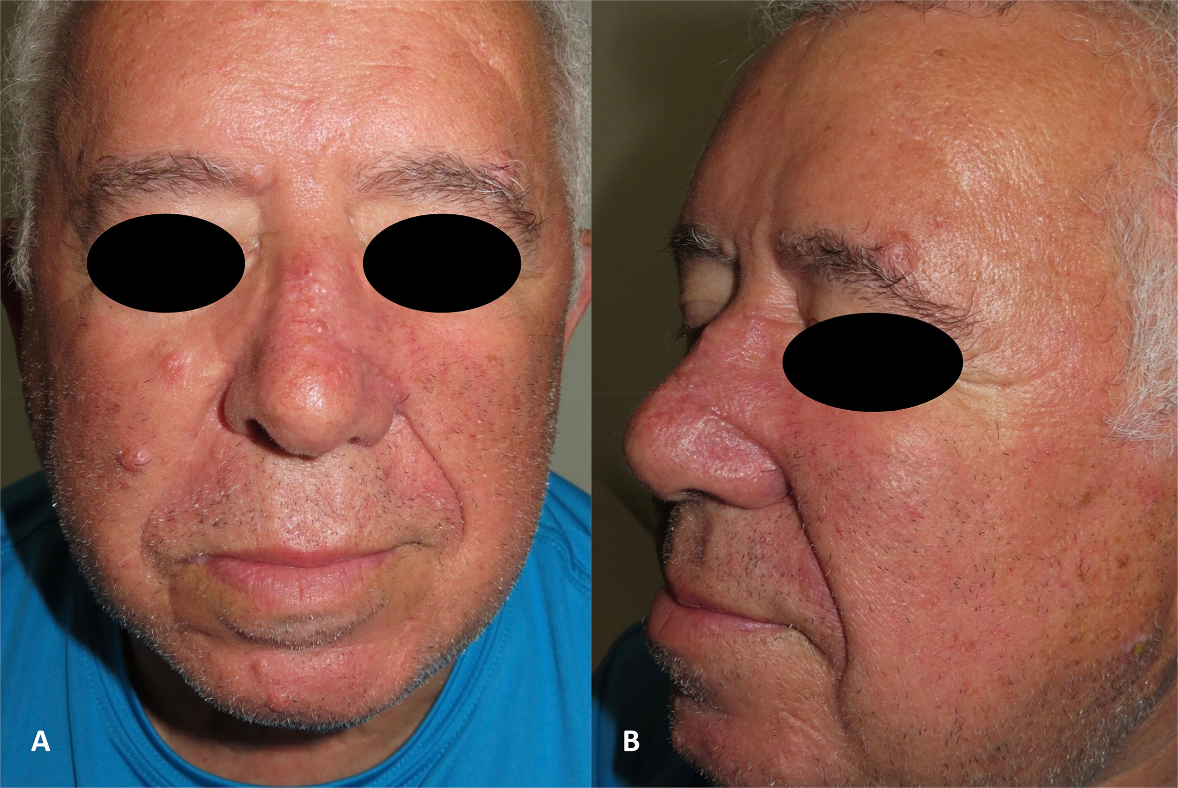 Colgajo de avance perialar crescéntico ampliado: modificación de una ...
