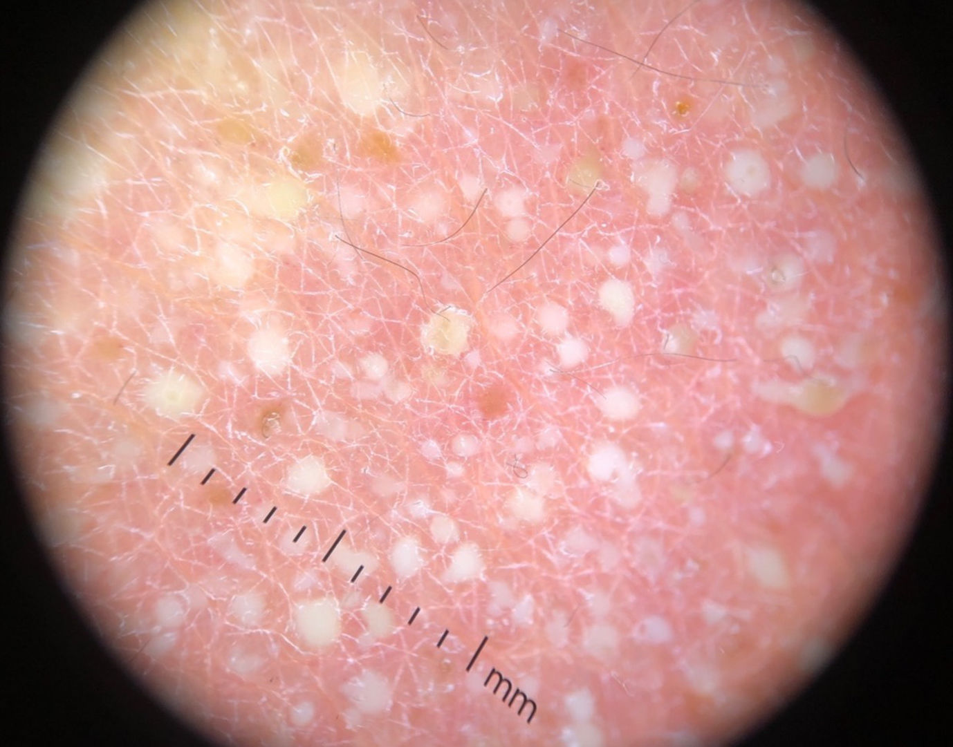 Pustulosis exantemática generalizada aguda secundaria a loxoscelismo ...