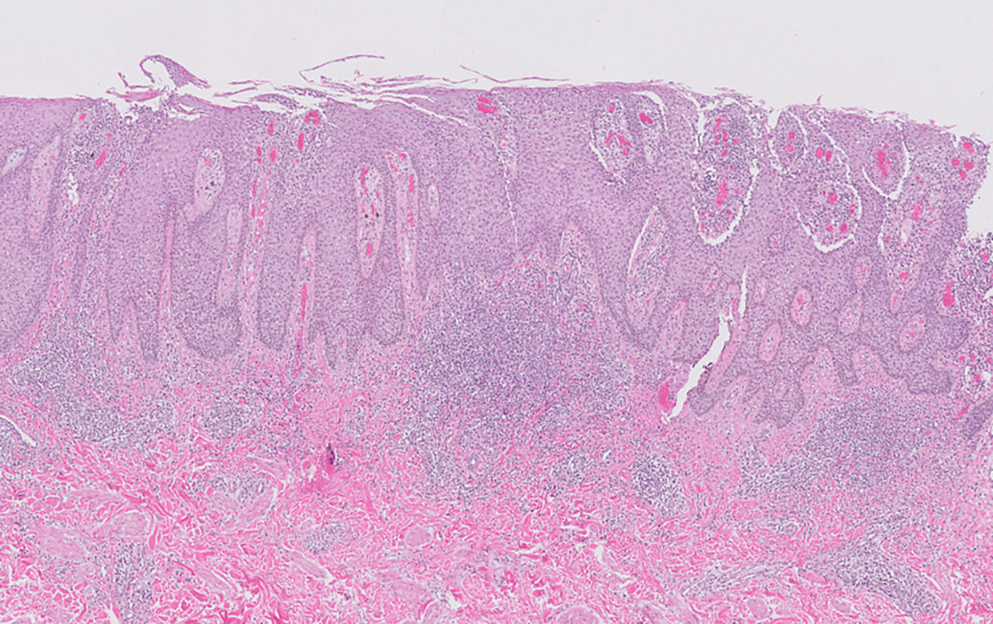 Dermatosis única en el pezón | Piel. Formación continuada en dermatología