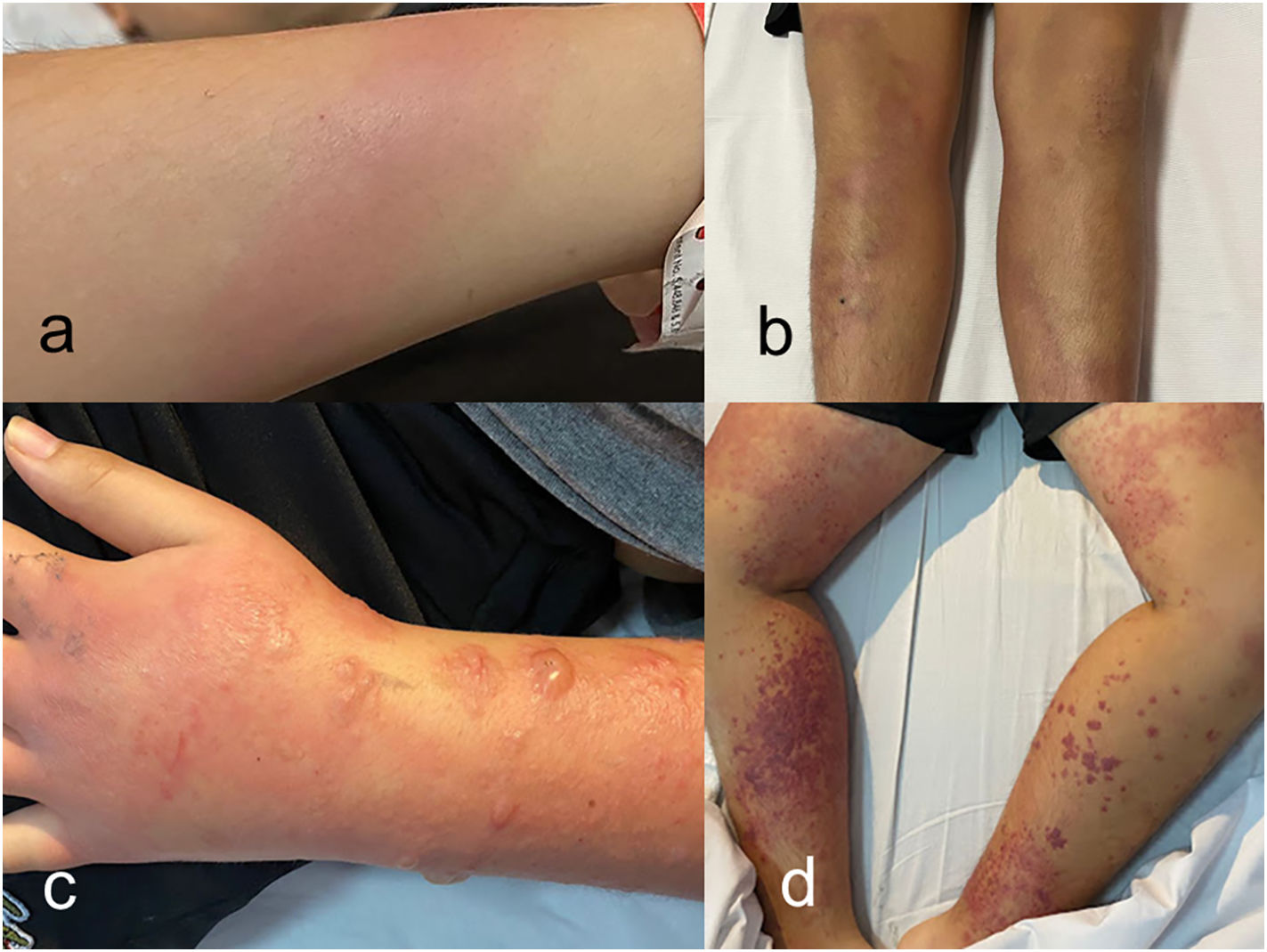 Síndrome de Sweet ampollar en un paciente con leucemia mieloide aguda ...