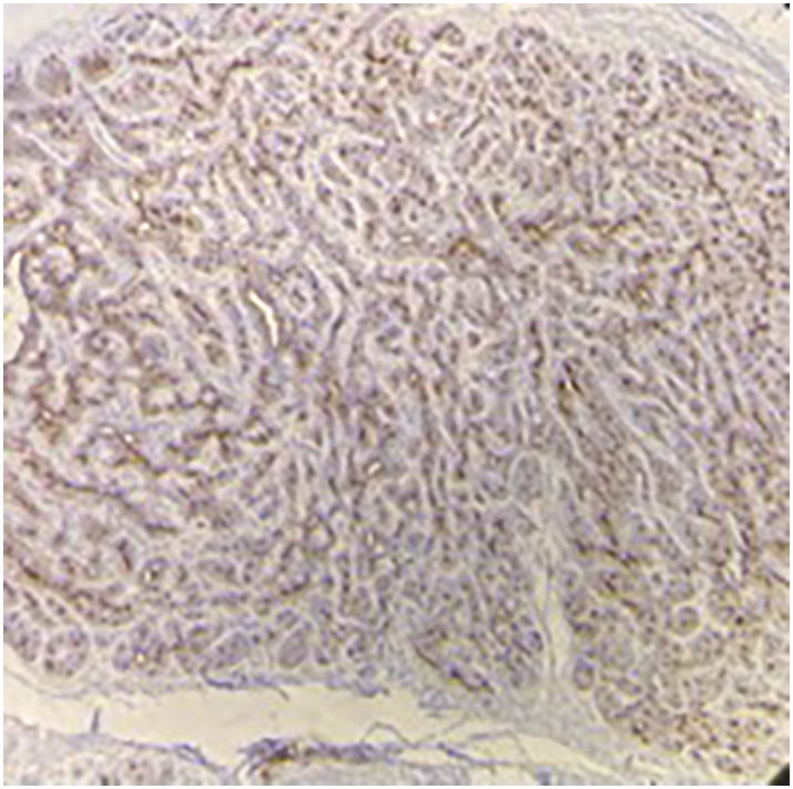 Nódulo de crecimiento acelerado en el rostro | Piel. Formación ...