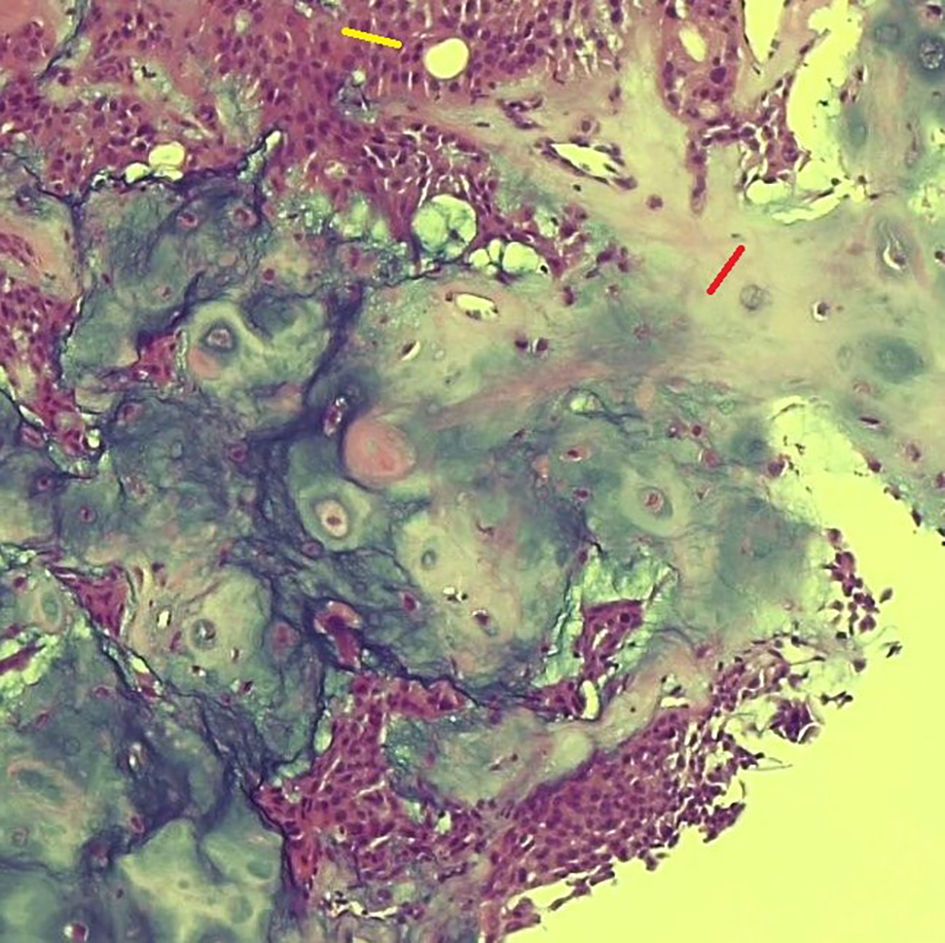 Nódulo facial con crecimiento rápido | Piel. Formación continuada en ...