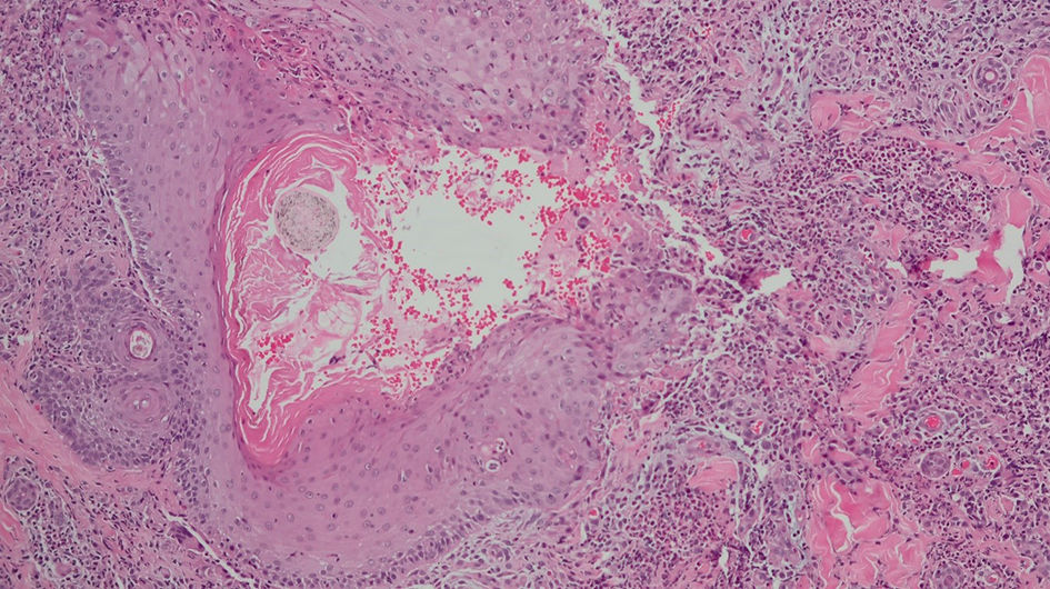 Foliculitis decalvante | Piel. Formación continuada en dermatología