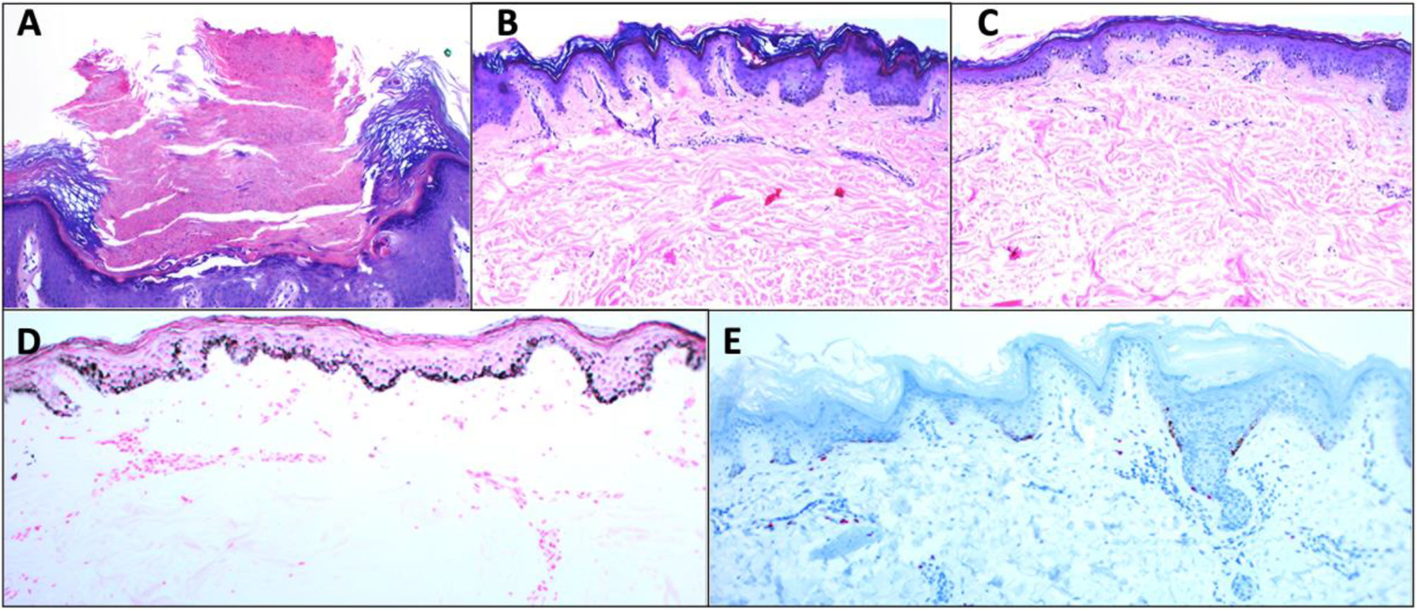 Leucodermia guttata como principal manifestación de la enfermedad de ...