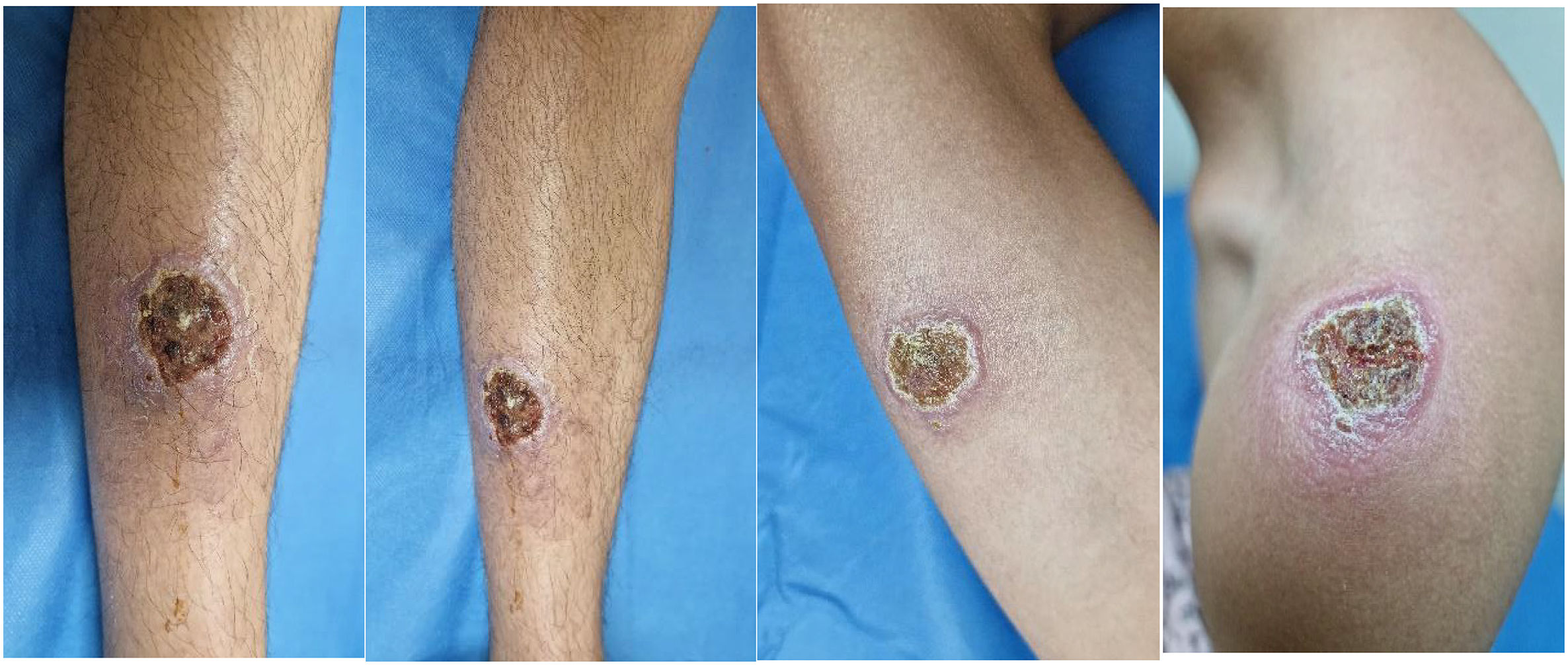 Leishmaniasis cutánea: experiencia en un hospital de referencia en ...