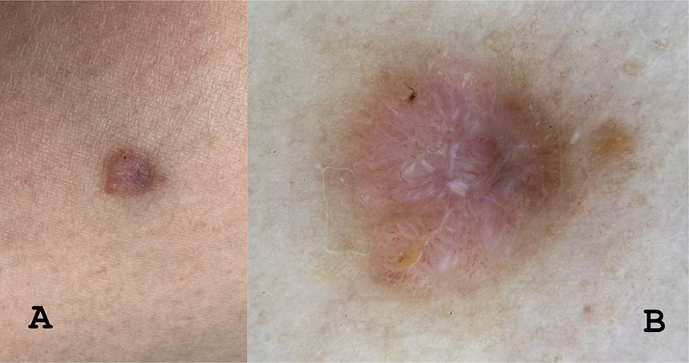 Fibroepitelioma de Pinkus | Piel. Formación continuada en dermatología