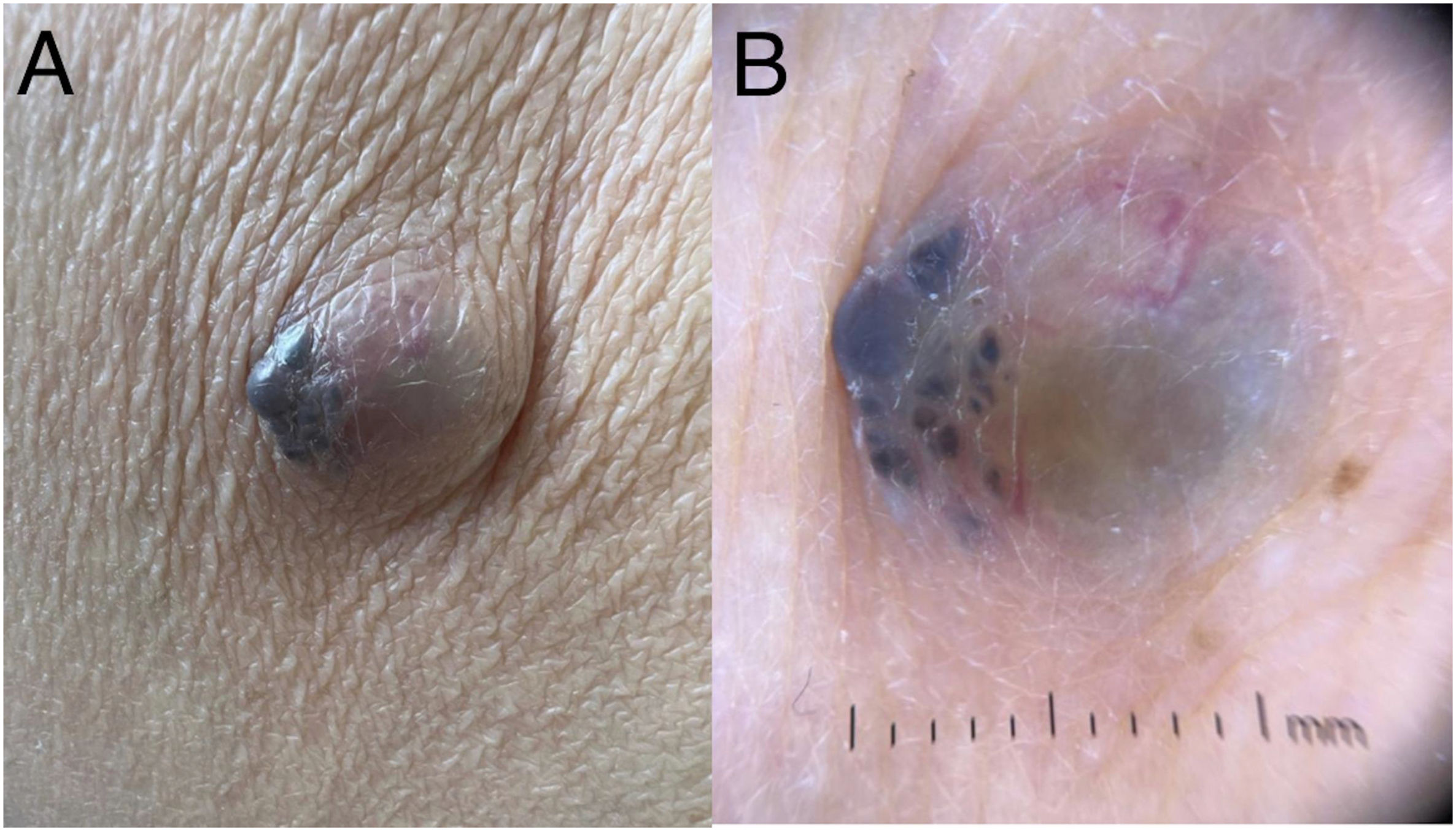 Nódulo en la rodilla | Piel. Formación continuada en dermatología