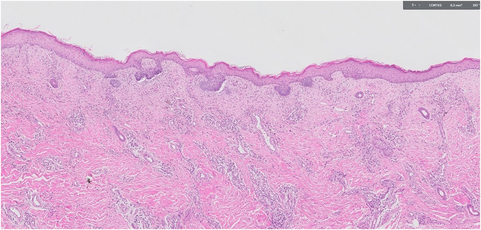 Placa ulcerada plantar | Piel. Formación continuada en dermatología