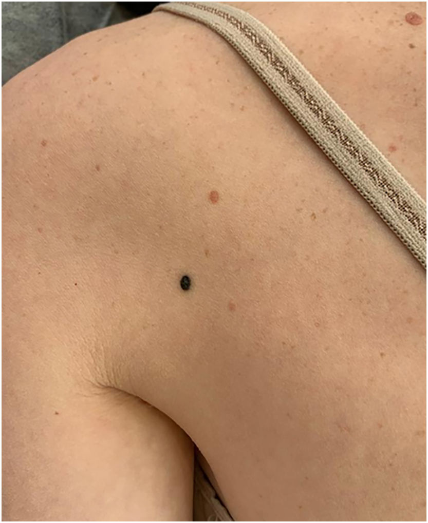 Más que una mancha. La importancia de la sospecha clínica | Piel ...