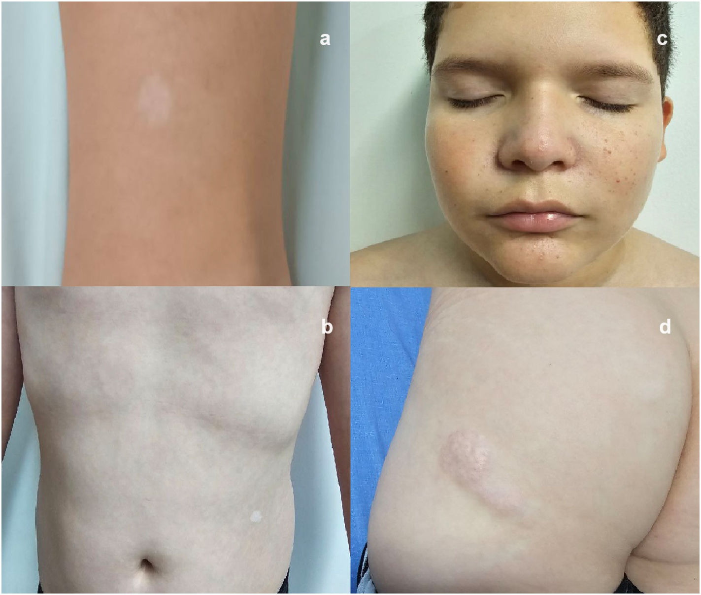 Complejo de esclerosis tuberosa: entre el diagnóstico erróneo y la ...