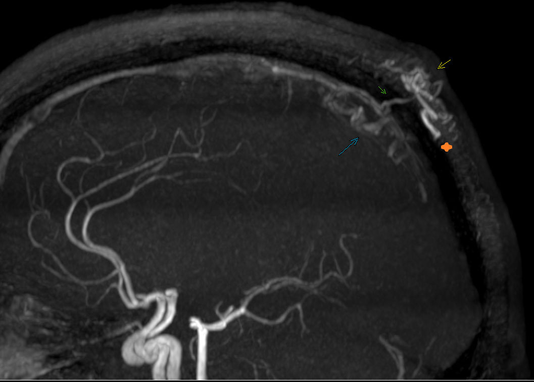 Fístula arteriovenosa dural del cuero cabelludo: la utilidad de la ...