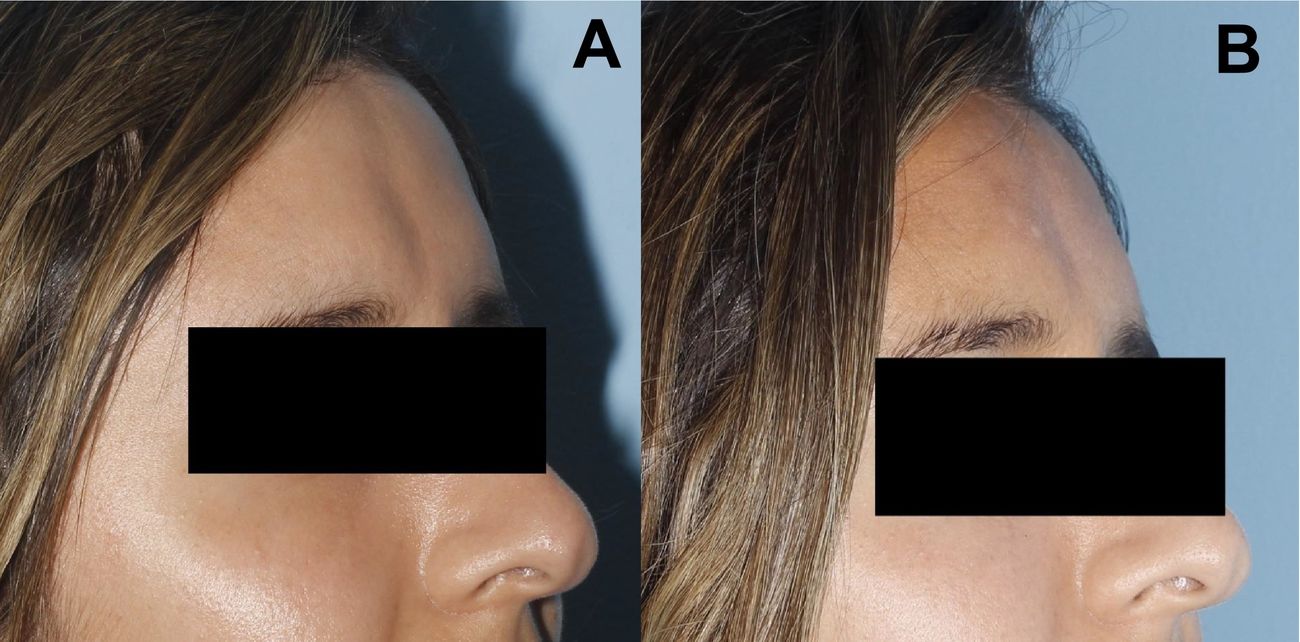 Tratamiento eficaz de la morfea en golpe de sable mediante fototerapia ...