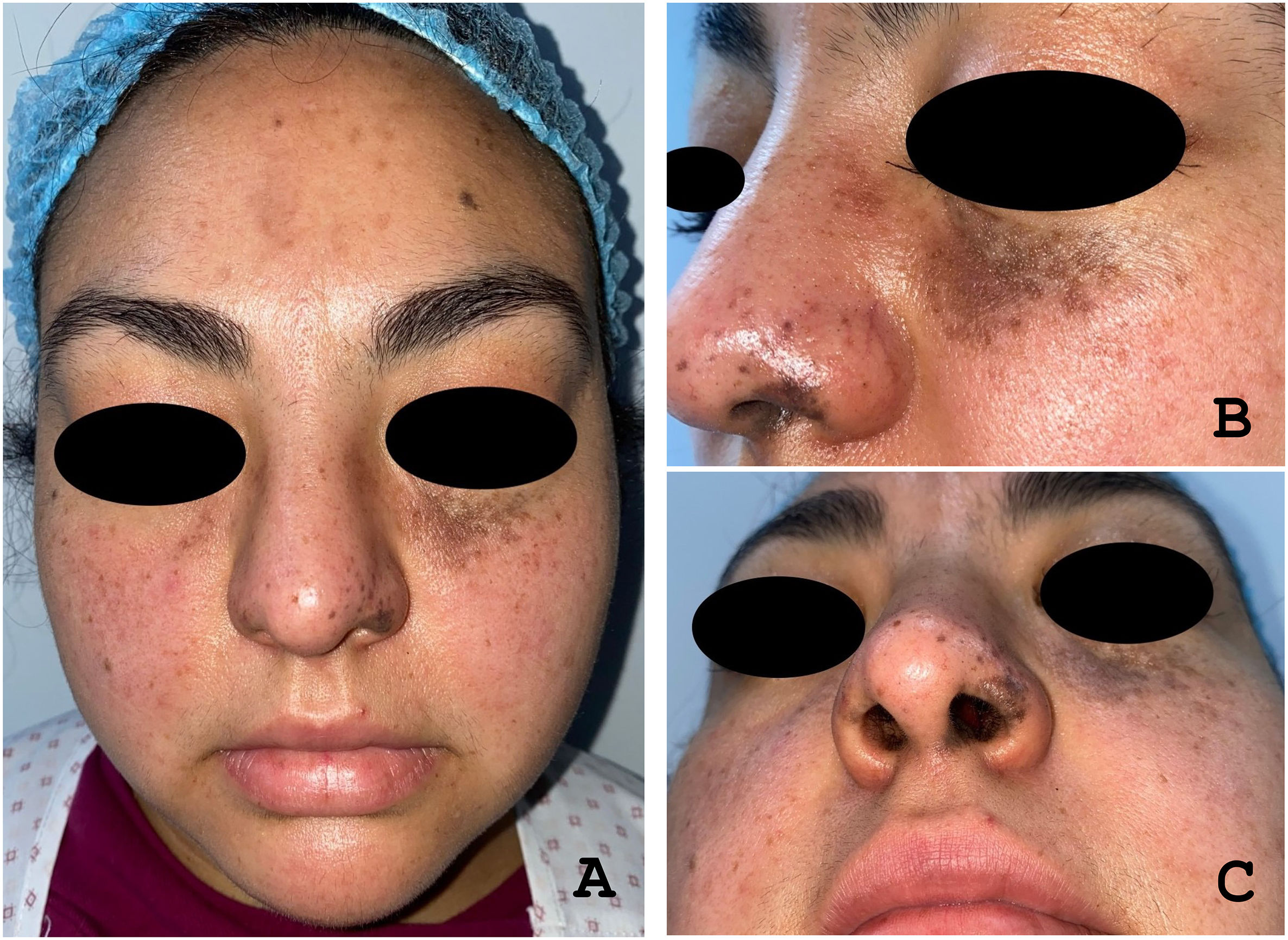 Nevo de Hori | Piel. Formación continuada en dermatología