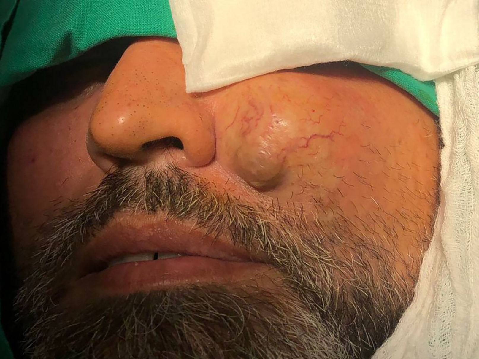 Siringoma condroide: descripción clínica e histopatológica | Piel ...