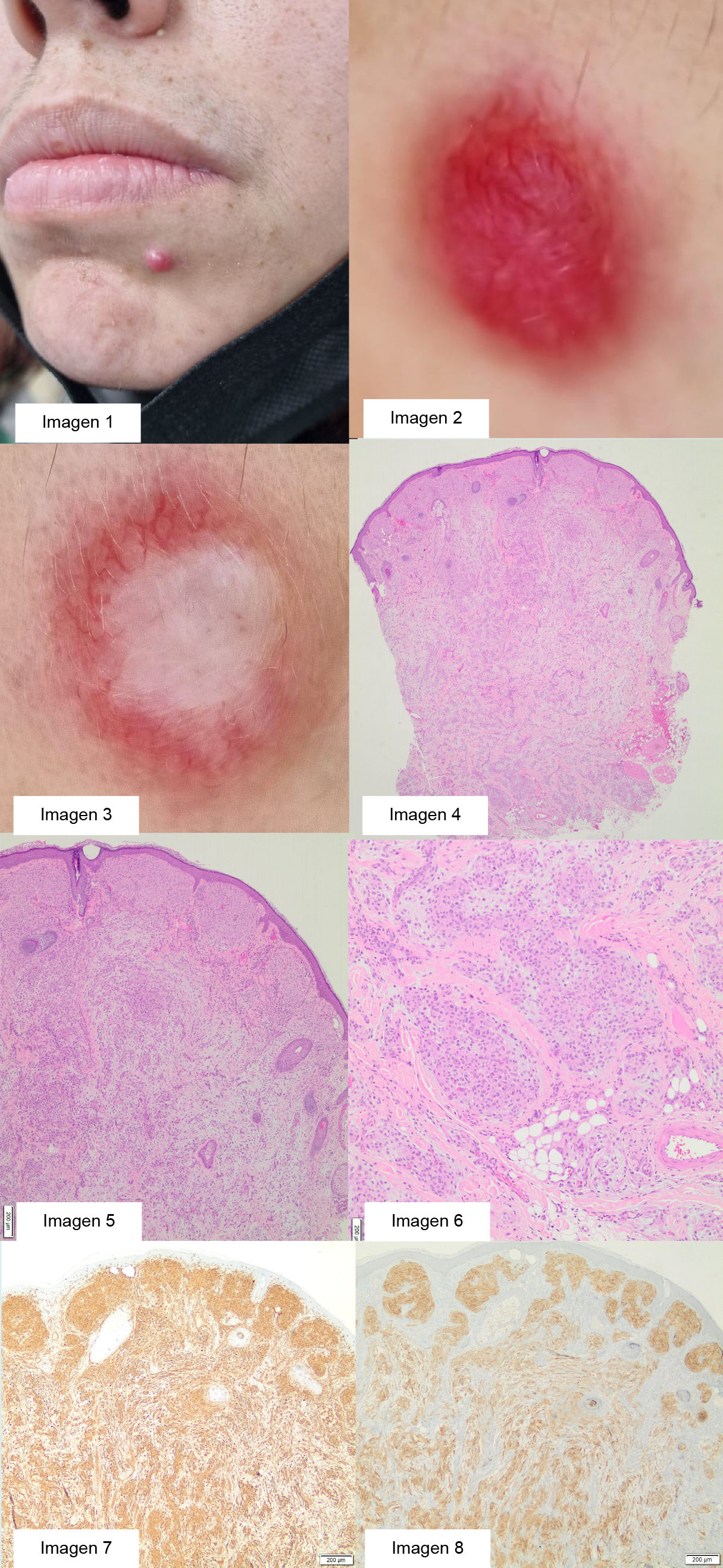 Neurotecoma celular: un diagnóstico diferencial de la pápula ...