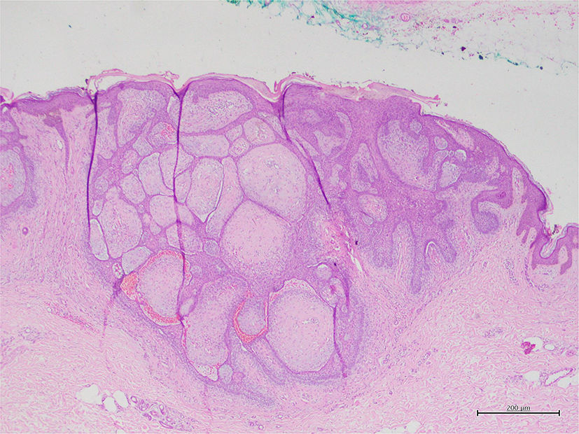 Fibroepitelioma de Pinkus | Piel. Formación continuada en dermatología