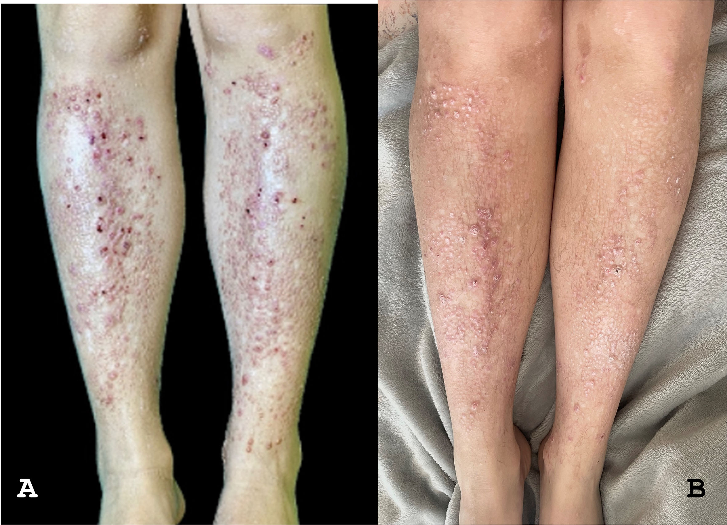 Epidermolisis bullosa pruriginosa satisfactoriamente tratada con ...