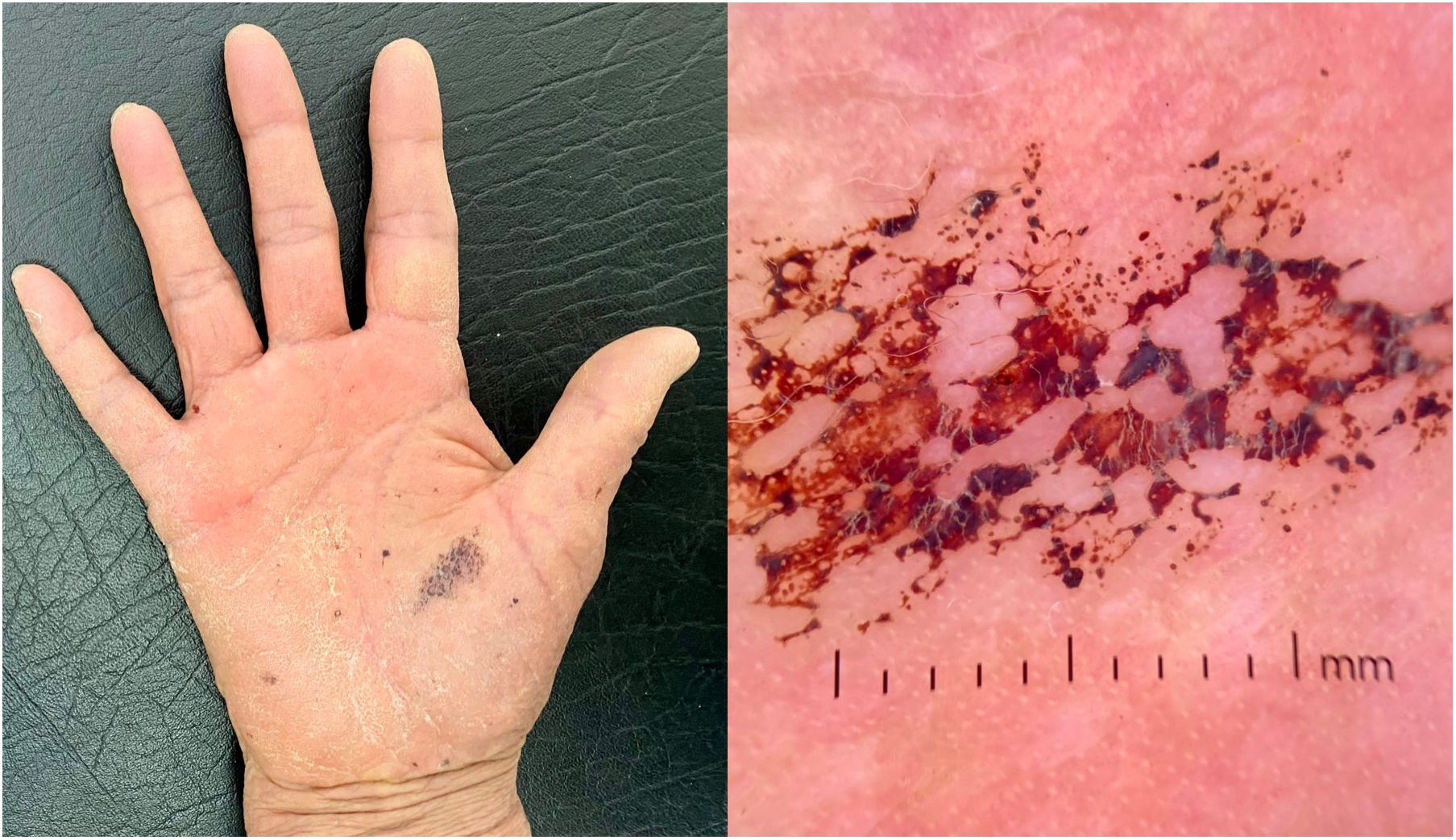 Enfermedad de Darier acral hemorrágico: hallazgos dermatoscópicos en 3 ...