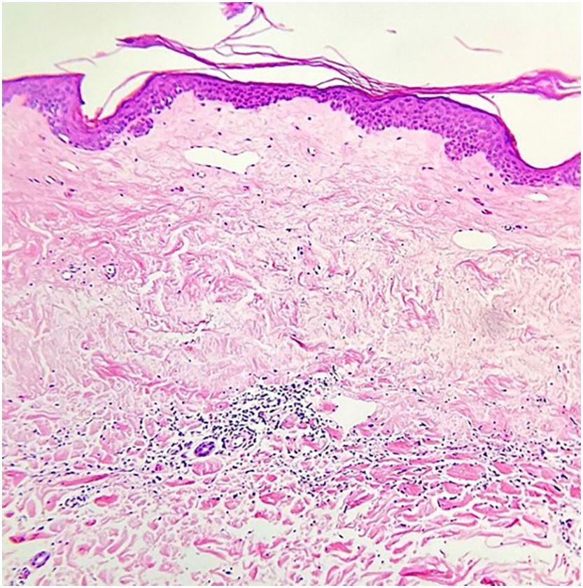 Liquen escleroso y atrófico y liquen plano vulvar: 2 entidades que ...