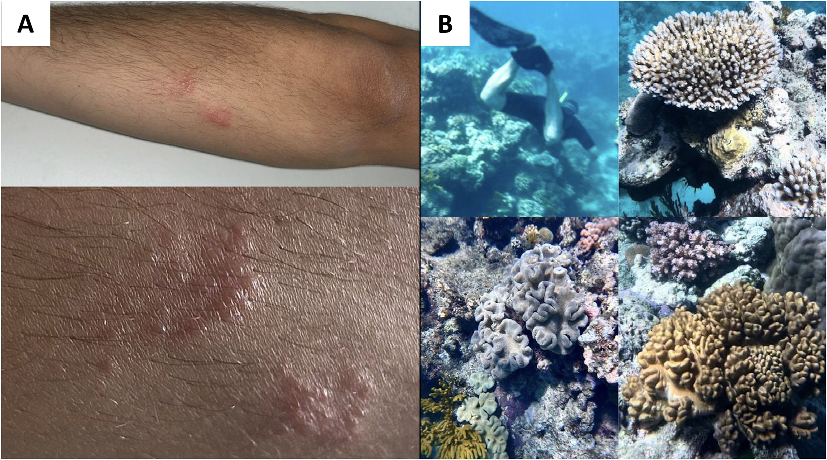 Dermatitis de contacto retardada por coral | Piel. Formación continuada ...