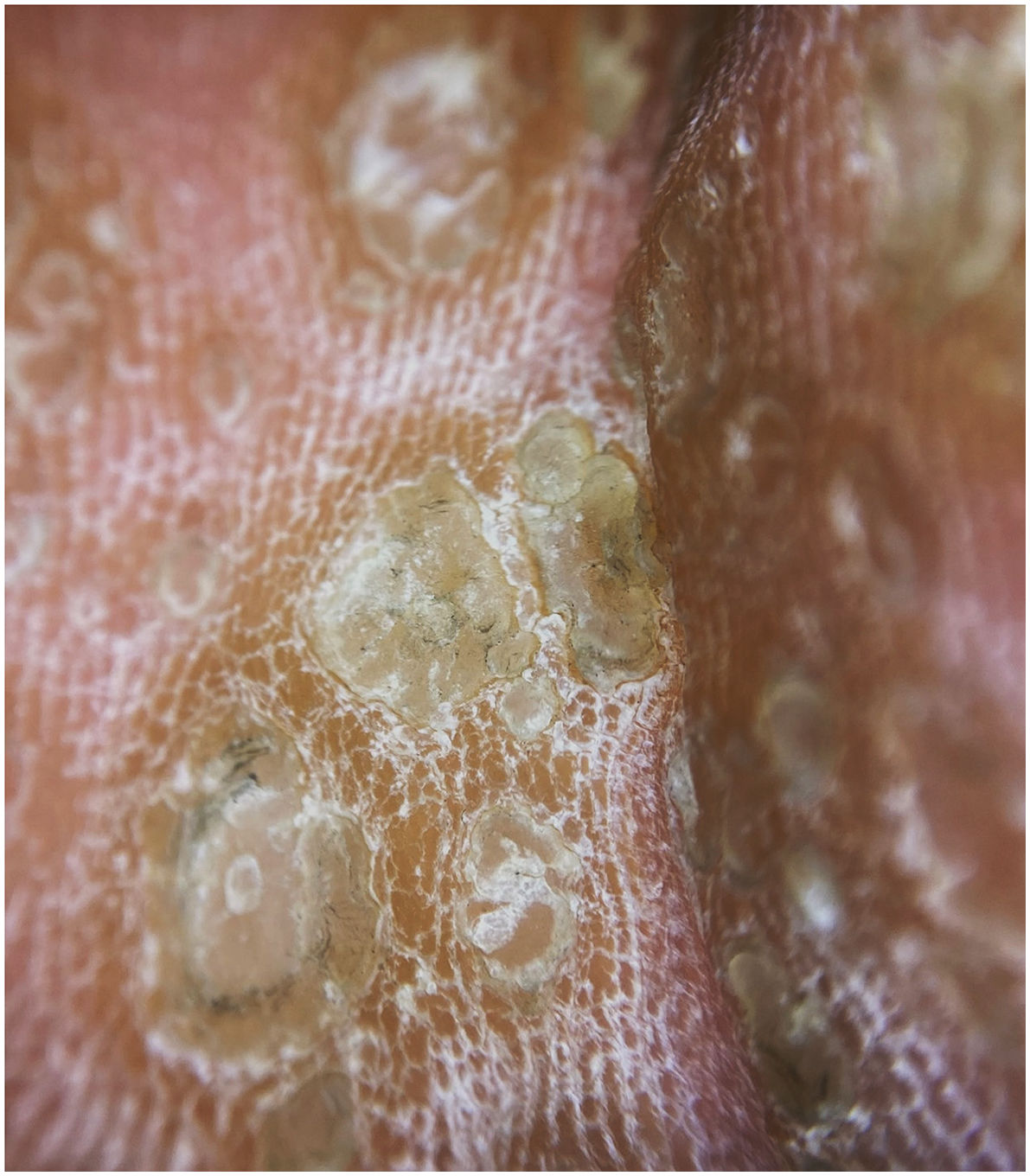 Queratodermia palmoplantar hereditaria tipo Buschke–Fisher–Brauer en un ...