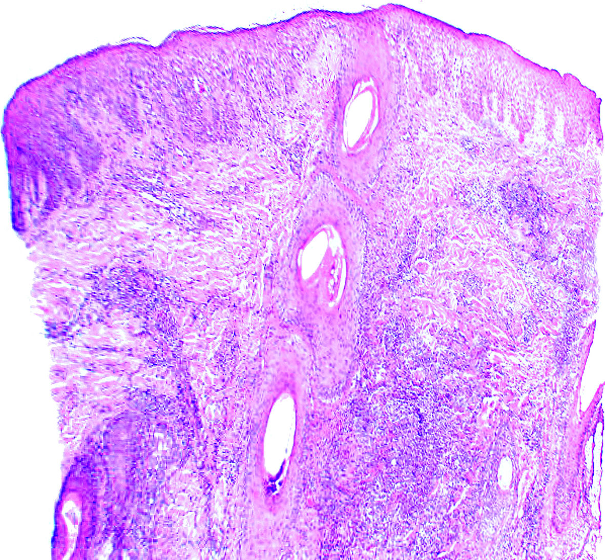 Alopecia cicatricial, celulitis disecante | Piel. Formación continuada ...